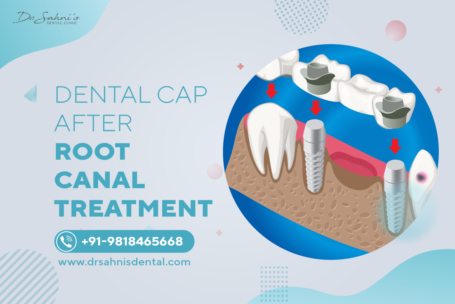 A-Cap or No Cap after Root Canal Treatment in South Delhi | Best Dental ...