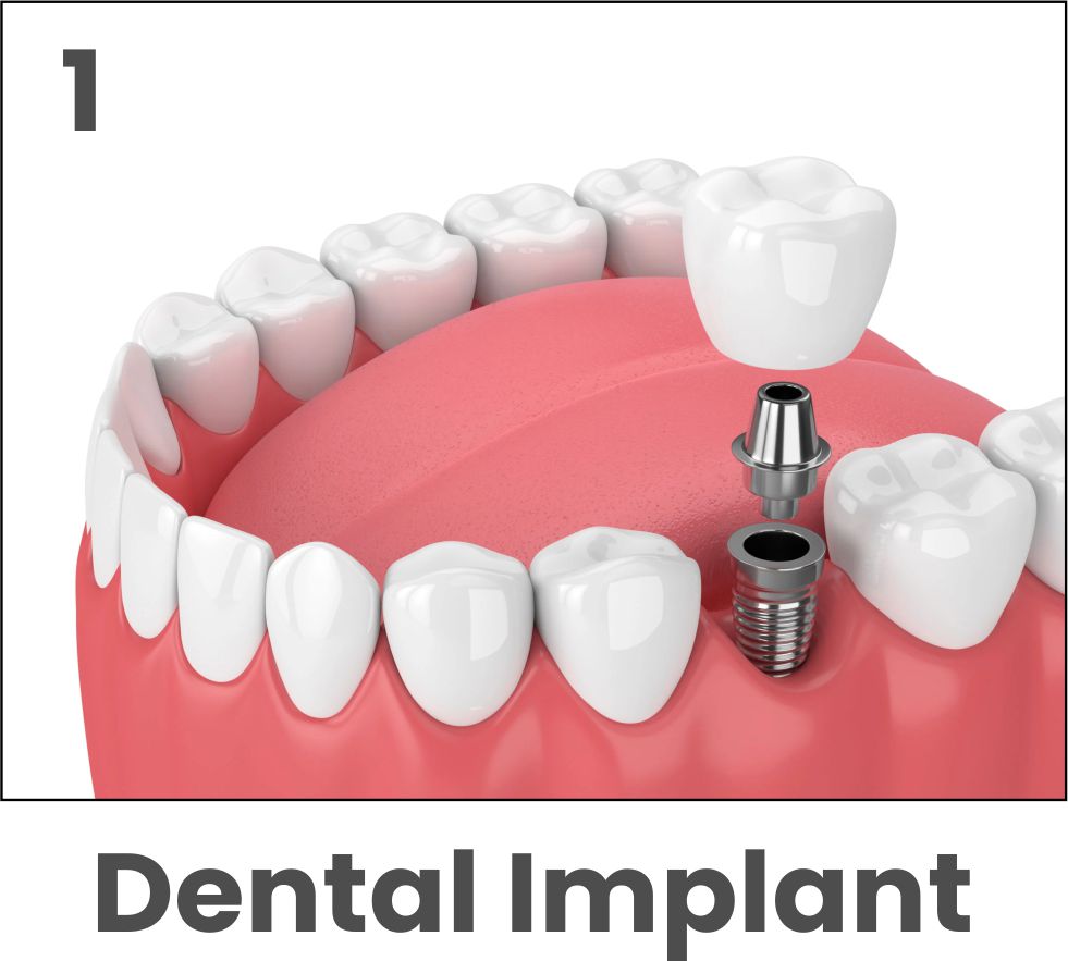 Top Reasons to Choose Dental Implants to Replace Single or Multiple ...
